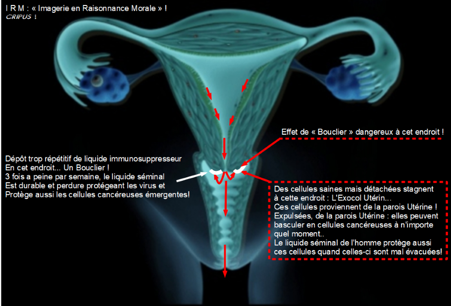 Le cancer du col de l'utérus et sa cause